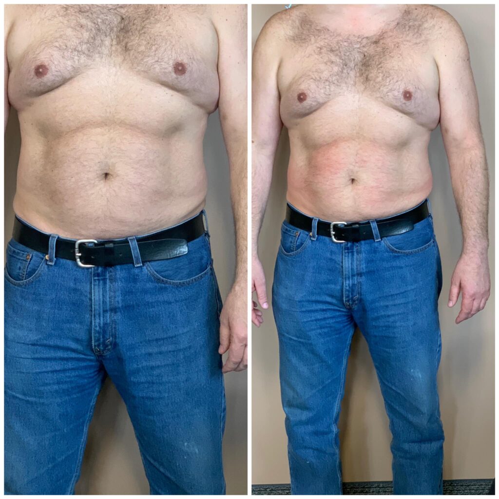 Body Contour Before and After Photos - HBOT Cryo Wellness Center
