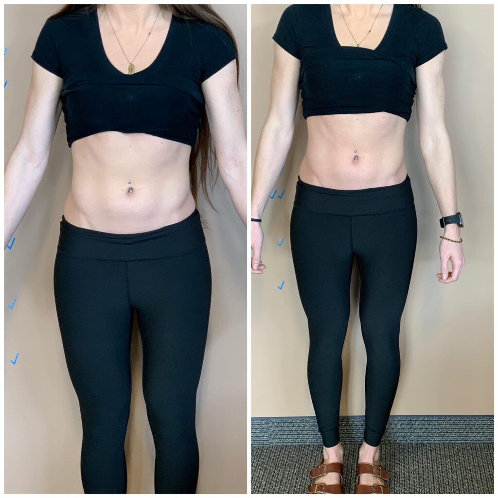 Body Contour Before and After Photos - HBOT Cryo Wellness Center
